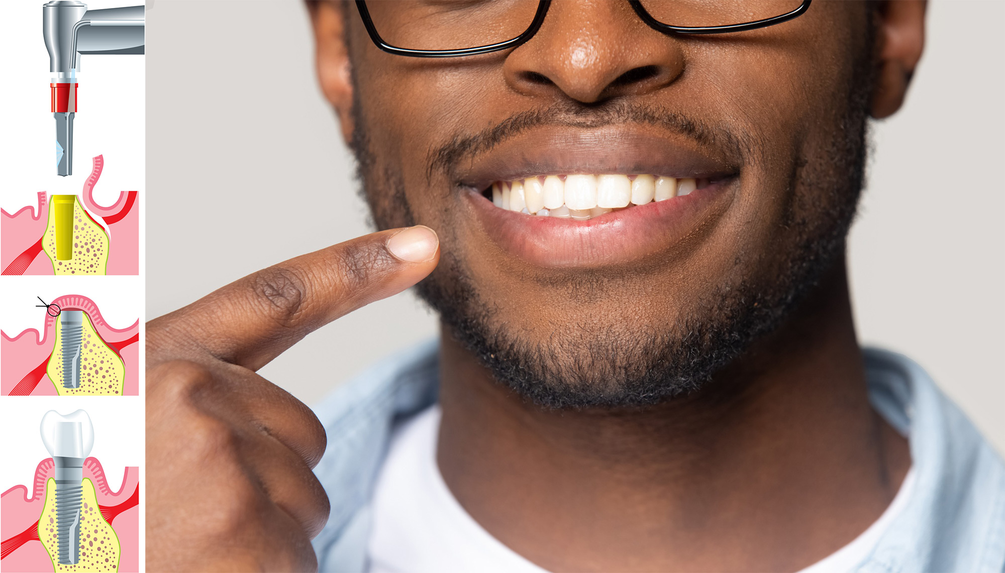 Understanding the Dental Implant Process: Step by Step Guide - Dr. Antipov