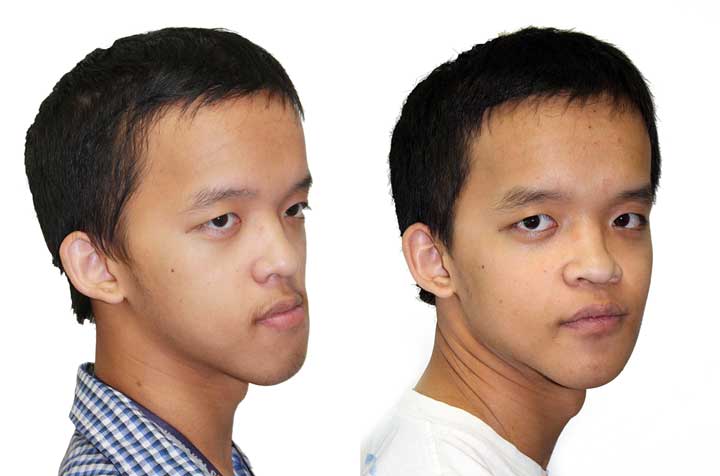 Facial Asymmetry Correction - Corrective Jaw Surgery - Dr. Antipov