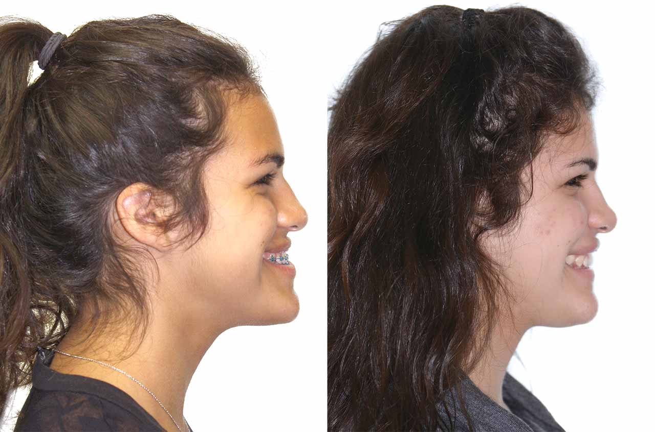 Face, Bite, and Airway Correction - Corrective Jaw Surgery - Dr. Antipov
