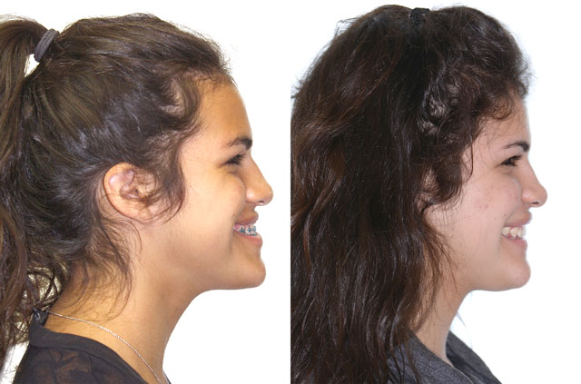 Face, Bite, and Airway Correction - Corrective Jaw Surgery - Dr. Antipov
