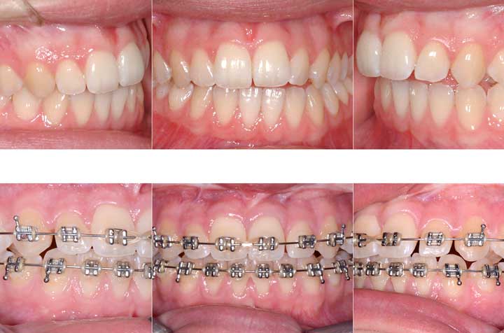 Face Asymmetry and Bite Correction Surgery Case - Corrective Jaw ...