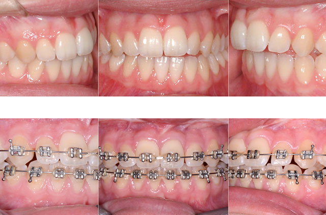 Face Asymmetry and Bite Correction Surgery Case - Corrective Jaw ...