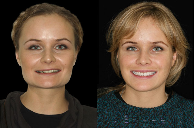 Orthognathic Facial Asymmetry Correction - Corrective Jaw Surgery - Dr ...