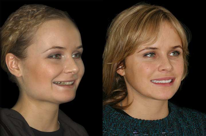 Orthognathic Facial Asymmetry Correction - Corrective Jaw Surgery - Dr ...