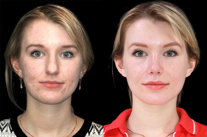 Contouring of the mandible, maxillary advancement and rhinoplasty ...