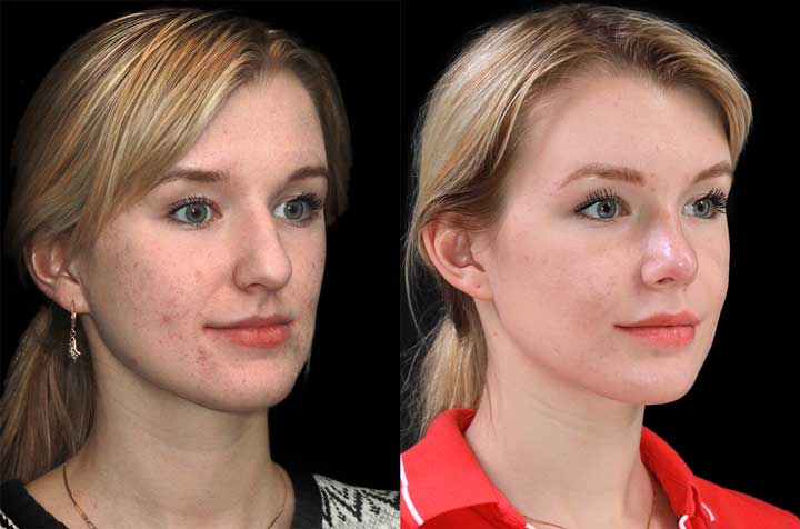 Contouring of the mandible, maxillary advancement and rhinoplasty ...