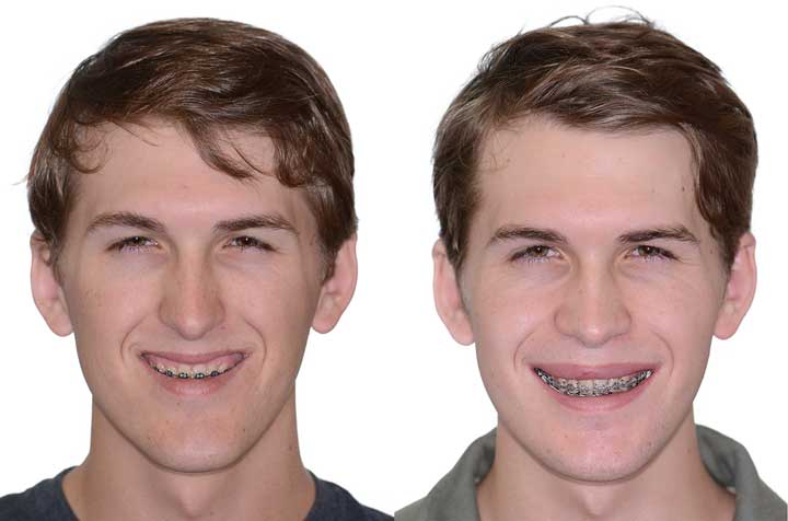 Double Jaw Orthognathic Surgery Corrective Jaw Surgery Dr Antipov double-jaw-orthognathic-surgery-corrective-jaw-surgery-dr-antipov