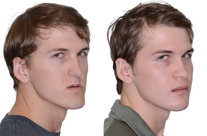 Double Jaw Orthognathic Surgery - Corrective Jaw Surgery - Dr. Antipov