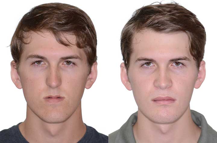 Double Jaw Orthognathic Surgery - Corrective Jaw Surgery - Dr. Antipov