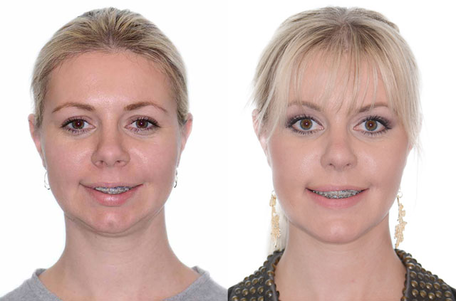 Corrective Jaw Surgery Complete Face Makeover - Corrective Jaw Surgery ...