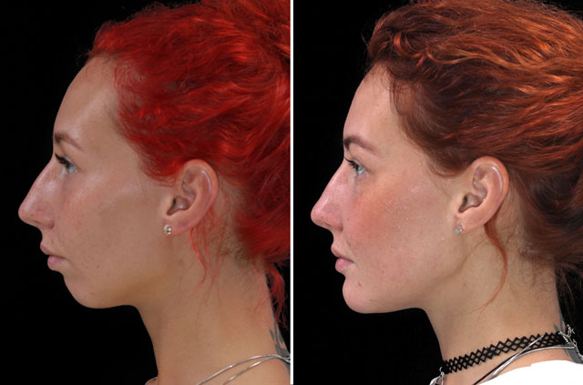 Correction Of Class II Malocclusion - Corrective Jaw Surgery - Dr. Antipov Correction Of Class II Malocclusion - Corrective Jaw Surgery - Dr. Antipov