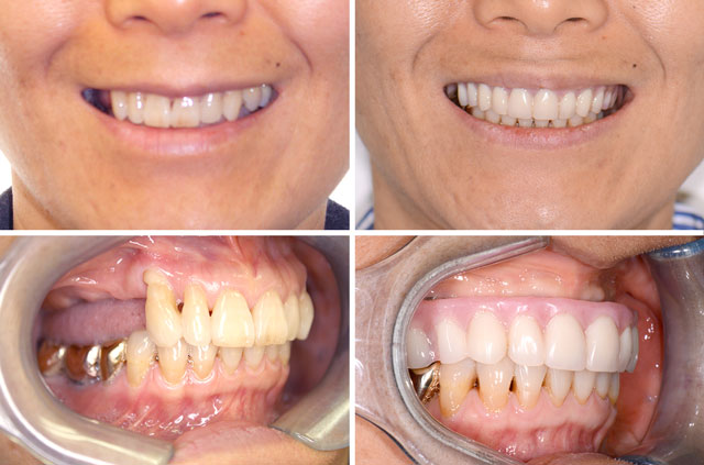 Immediate Implants and Teeth All-On-4 on Upper Jaw - Dental Implants ...